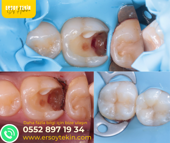 Diş Dolgu Fiyatları 2025 - Diş Hekimi Ersoy Tekin